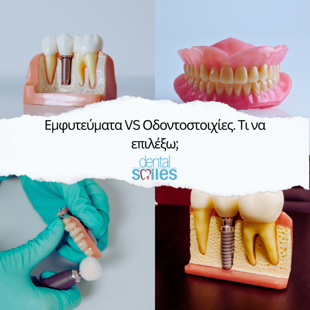 Εμφυτεύματα δοντιών ή γέφυρες; | dentalsmiles